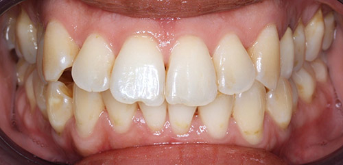 Lingual Braces Orthodontist FAQ - Frequently Asked Questions